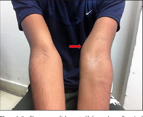 Enlarged Right Epitrochlear Lymph Node