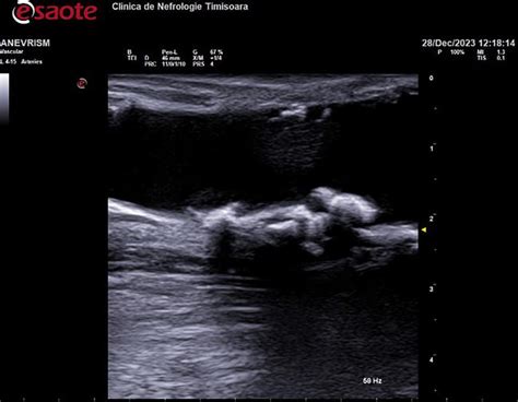 Arteriovenous Fistula Ultrasound Assessment Intechopen