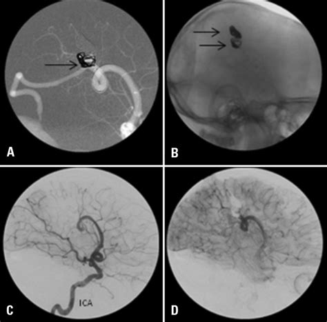 A Road Map Angiogram During The Deployment Of The Detachable