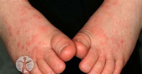 Infantile Papular Acrodermatitis Image