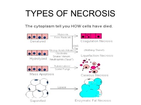 Coagulative Necrosis Histology Diagram