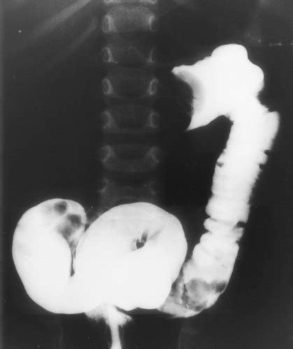 Barium Enema Intussusception