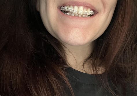 Lightforce 3d Printed Braces R Braces