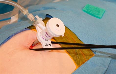 Laparoscopic Ileocolectomy For Crohn Disease Clinical Tree