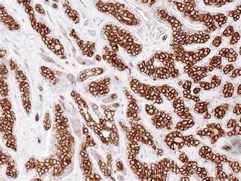 Adenoid Cystic Carcinoma Of Breast Cd117