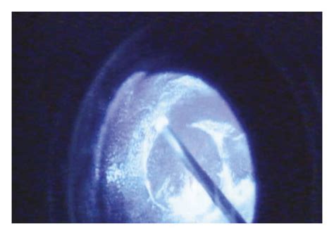 Formation Of Surgical Posterior Vitreous Detachment Pvd A The