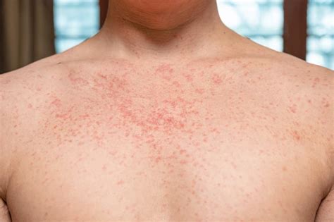 Measles Elimination In Us Is Under Renewed Threat Cdc Warns