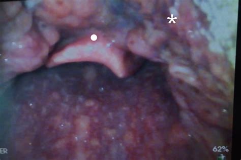 A Man With Sore Throat—a Case Report Jetem