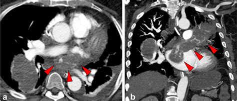 Life Threatening Hemoptysis And Bradycardia In Metastatic Sarcoma With Vascular Invasion And