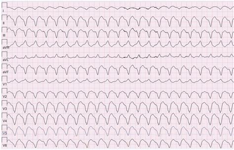Wide Complex Tachycardias Emergency Medicine Clinics