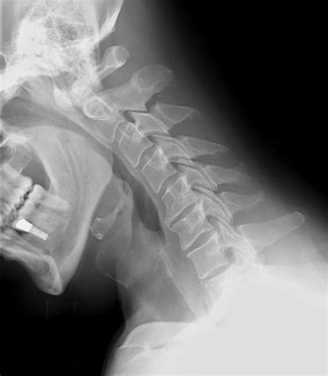 Cervical Spine Flex Buyxraysonline
