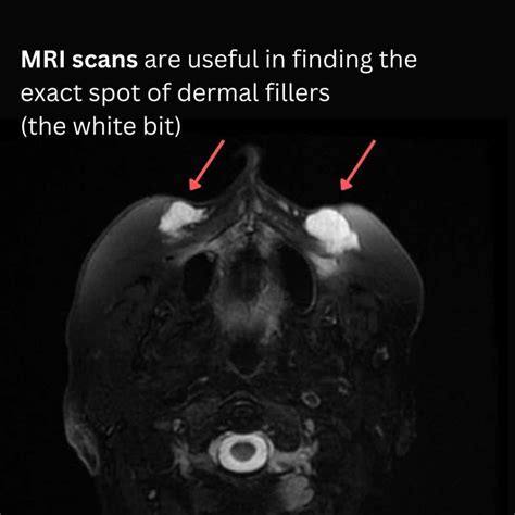 Dermal Fillers Side Effects Dr Davin Lim