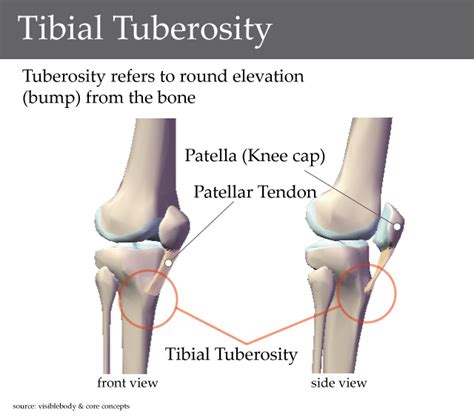 Tibial Tuberosity Patrickersig Flickr