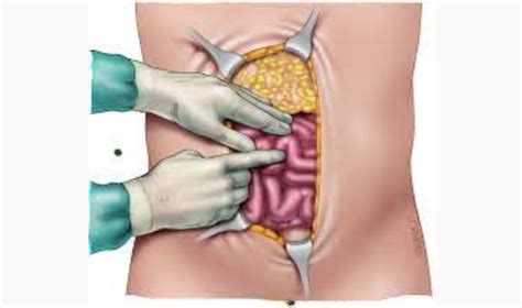 Exploratory Laparotomy In Vijayawada Dr Vamsavardhan P