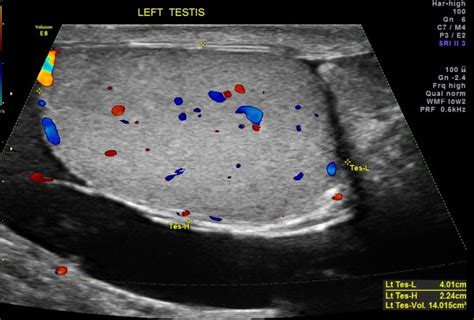 Complex Hydrocele Looking Through A Transducer