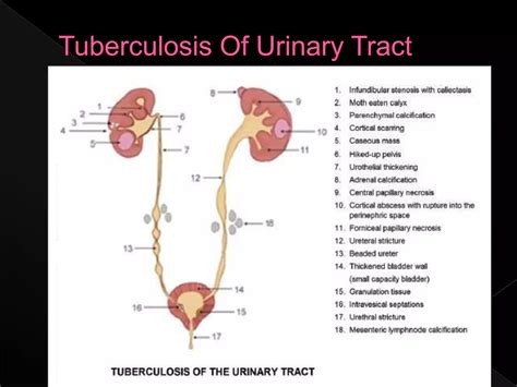 Renal Tuberculosis Radiology Pptx