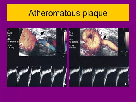 Renal Doppler Ultrasound Ppt