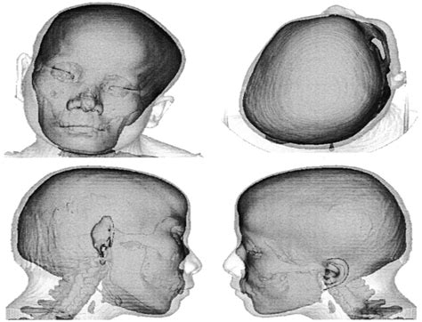 Craniofacial Deformity In Patients With Uncorrected Congenit