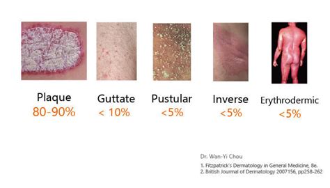 What Is The Main Cause Of Psoriasis Common Types Of Psoriasis Aromase