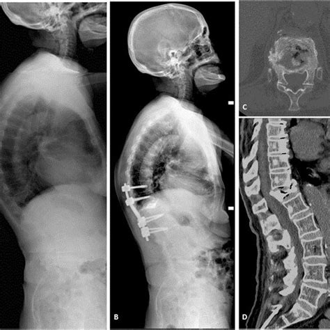 Sample Case Of 3 B 2 Patient Treated With L2 Corpectomy And Posterior Download Scientific