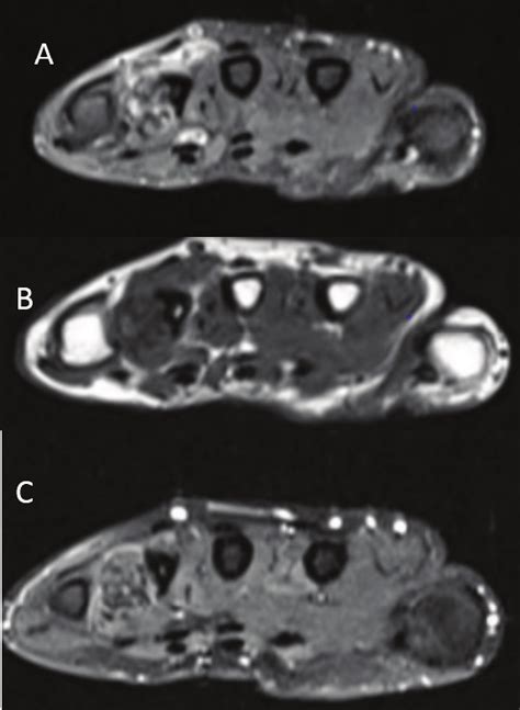 Juxtacortical Chondroma In A 37 Year Old Female Presenting With A