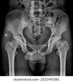 Young Female Pelvis X Ray Normal