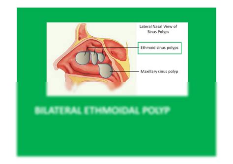 Solution Nasal Polyps Nose Disorder Studypool