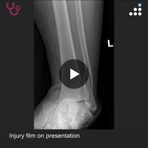 Open Subtalar Fracture Dislocation In 46f Case By Dr Szatkowski Orthobullets Posted On The