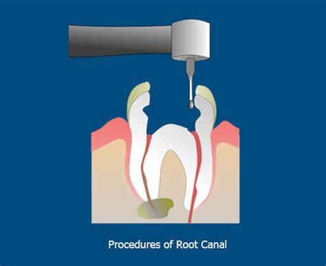 Dental Treatment Guide Step By Step Root Canal Process