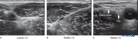 Ultrasound Guided Fascia Iliaca Nerve Block Nysora