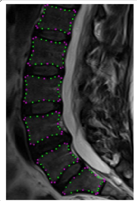Statistical Shape Modelling Ssm Template Of The Lumbar Spine