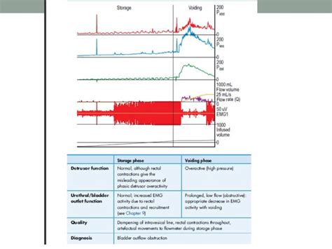 Urology Neurogenic Bladder Urodynamicspptx