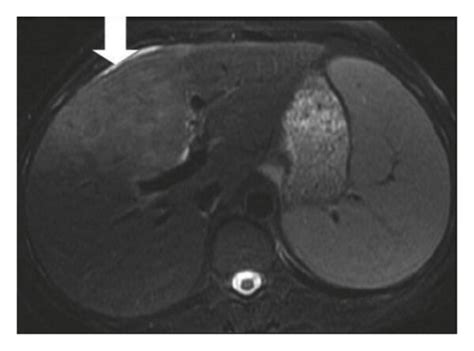 Intrahepatic Cholangiocarcinoma A Axial T1 Weighted And B Axial Download Scientific Diagram