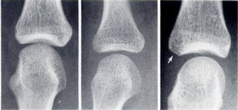 A Normal Contour Of Left Third Metacarpophalangeal Joint In 38year Old