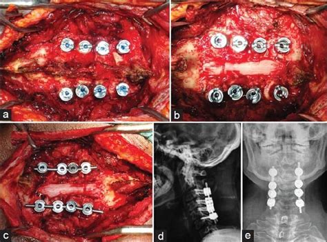 آرتروز گردن چه علائمی دارد؟ علت و درمان بدون جراحی کلینیک درمان