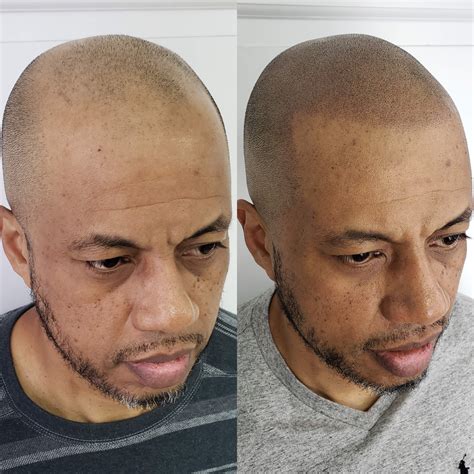 The Transformative Power Of Scalp Micropigmentation — Got Scalp