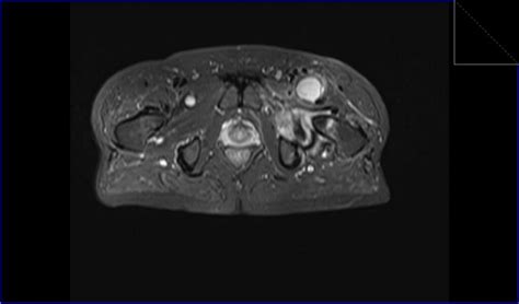 Iliopsoas Bursitis Mri Iliopsoas Muscles Injuries Musculoskeletal