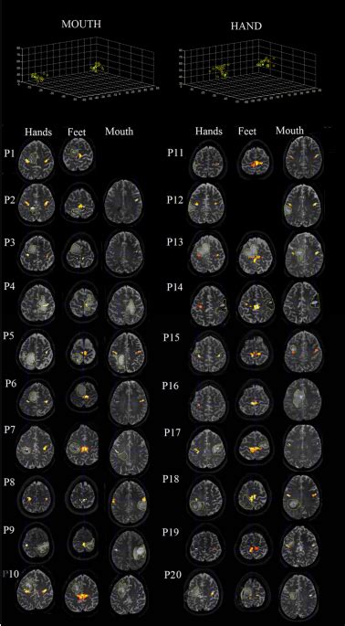 Neurosurgical Lesions To Sensorimotor Cortex Do Not Impair Action Verb