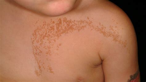 Epidermal Nevus Face