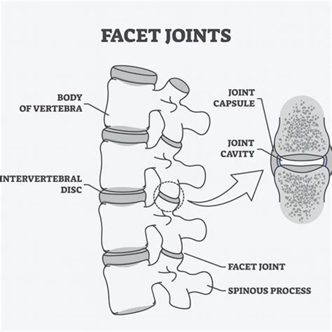 Lumbar Facet Syndrome Non Surgical Solutions For Lasting Lower Back Relief