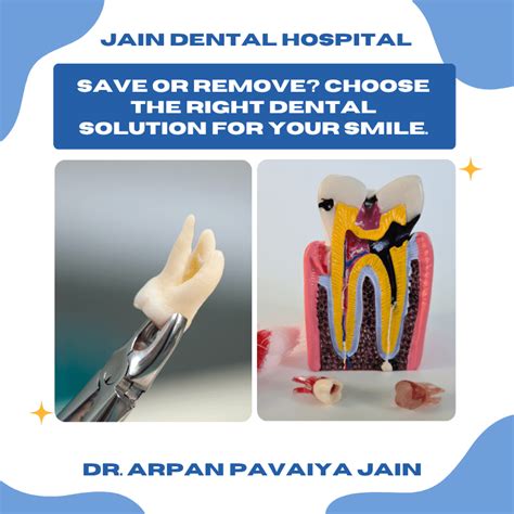 Root Canal Vs Tooth Extraction Which Option Is Better