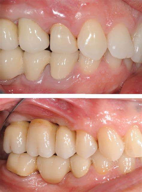 Peri Implant Mucositis Of The 15 And Peri Implantitis Of The 17