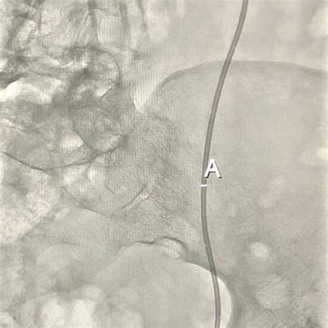 Nephrostogram After Anterograde Stenting Download Scientific Diagram