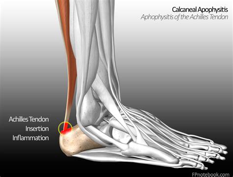 Calcaneal Apophysitis