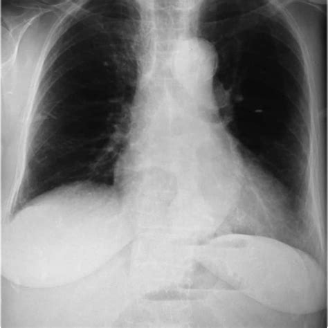 Plain Abdominal Radiography Showing Diffuse Gas Distension Of The Colon Download Scientific