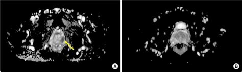 Representative Cases With Positive A Prostate Cancer Positive Part Is Download Scientific