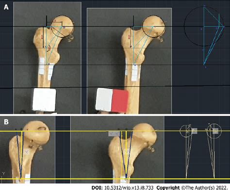 Pdf Risk Modeling Of Femoral Neck Fracture Based On Geometric