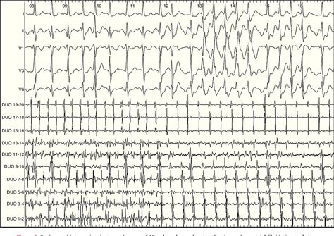 11 Atrial Flutter After Vernakalant Administration For Atrial Fibrillation Cardioversion