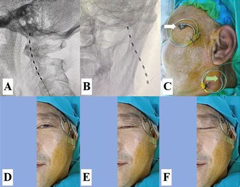 Frontiers Successful Treatment Of Intractable Neuralgia In Patients