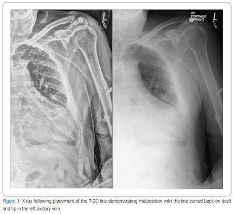 PICC Line Malposition Complicated By Patient Delirium COVID Infection And Limited Vascular